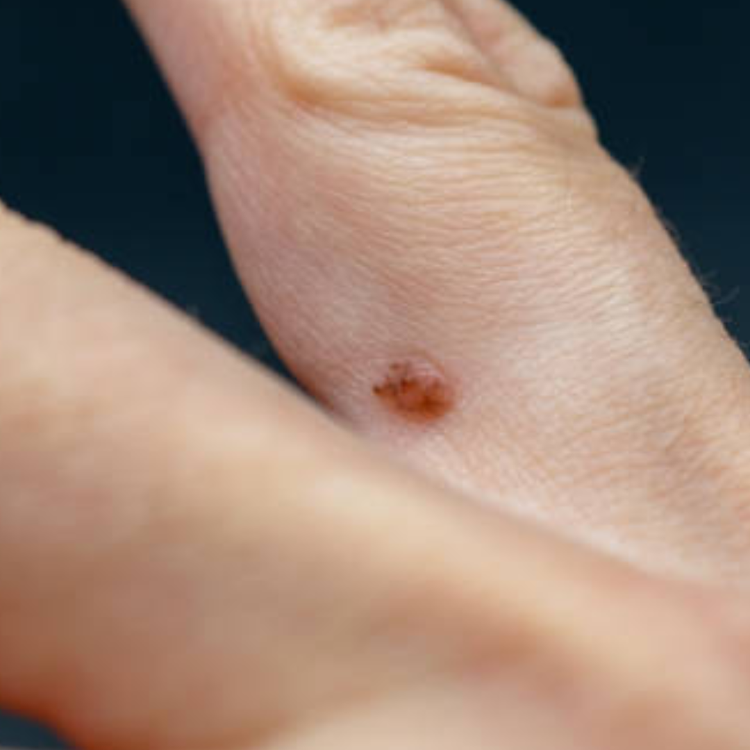 Mole On Body: शरीर के इन हिस्सों पर है तिल, जानिए इसका शुभ और अशुभ संकेत