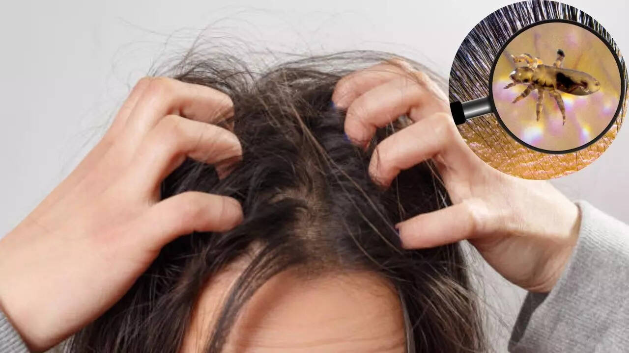 बालों में जुएं ने जमा लिया है डेरा तो आज ही अपनाएं ये असरदार घरेलू